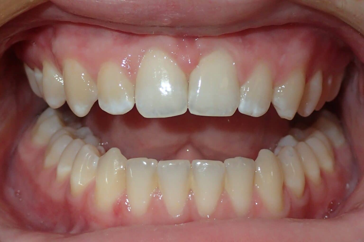 Lingual Braces Invisible Braces C5 Hidden Orthodontics - ALTASMILES