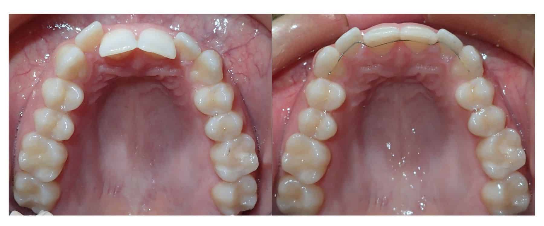 C⁵ Hidden Orthodontics Treatment Enhancements - ALTASMILES